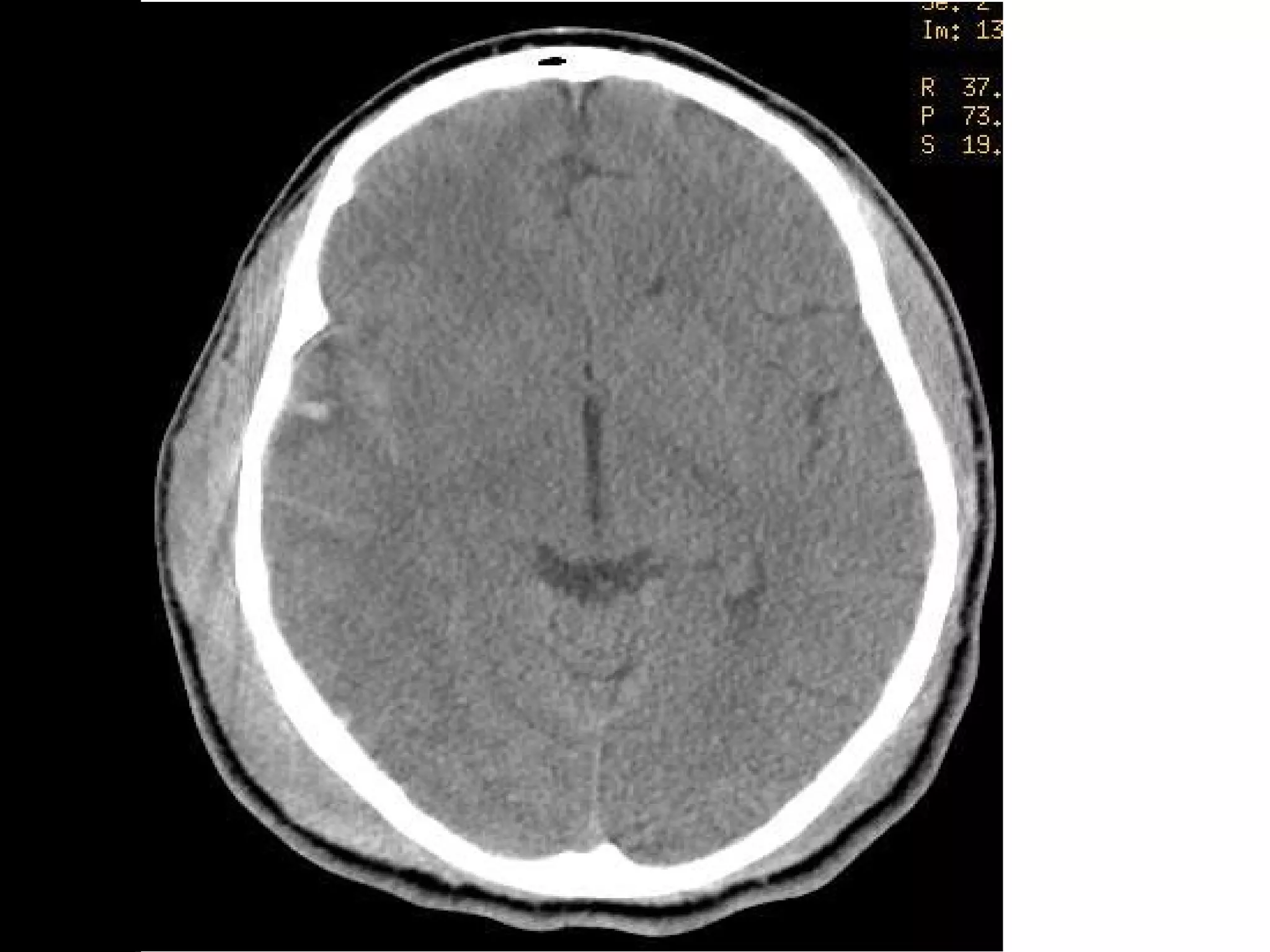 Imaging in head trauma | PPT
