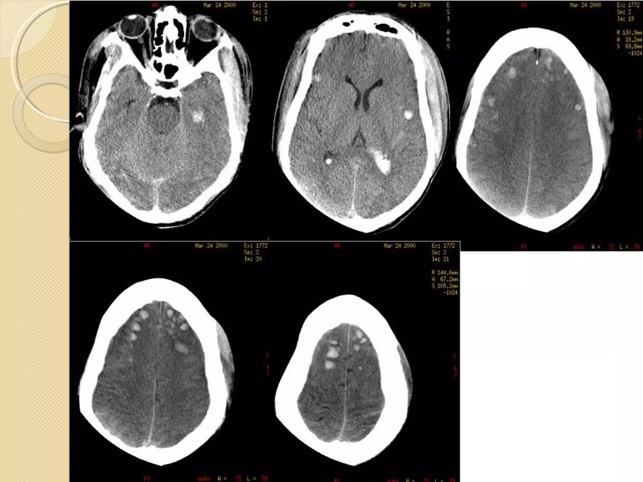 Imaging in head trauma | PPT