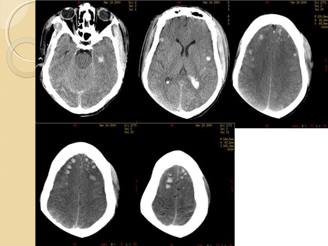 Imaging in head trauma | PPT