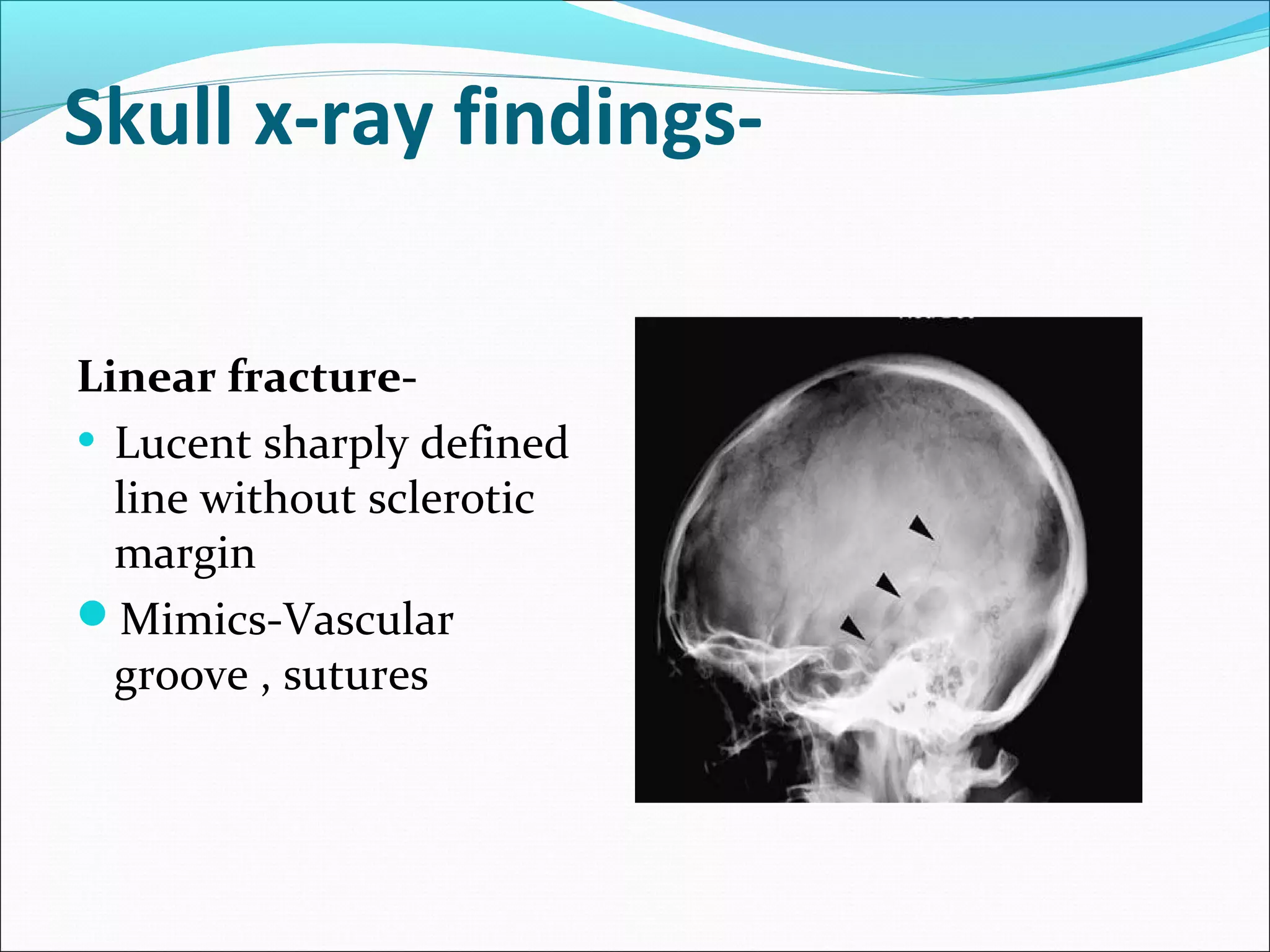 Imaging in head trauma | PPT