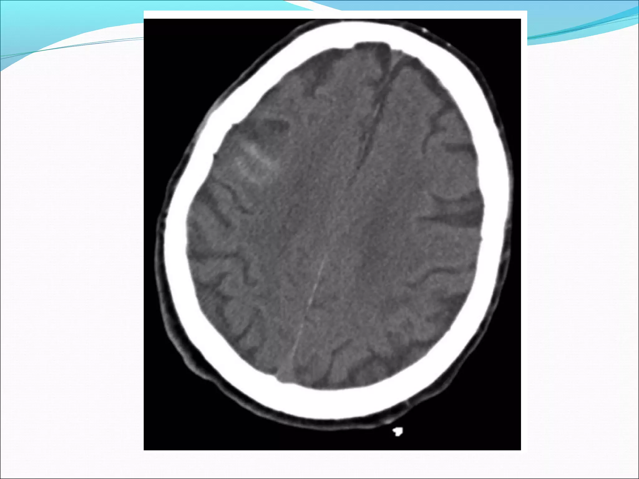 Imaging in head trauma | PPT