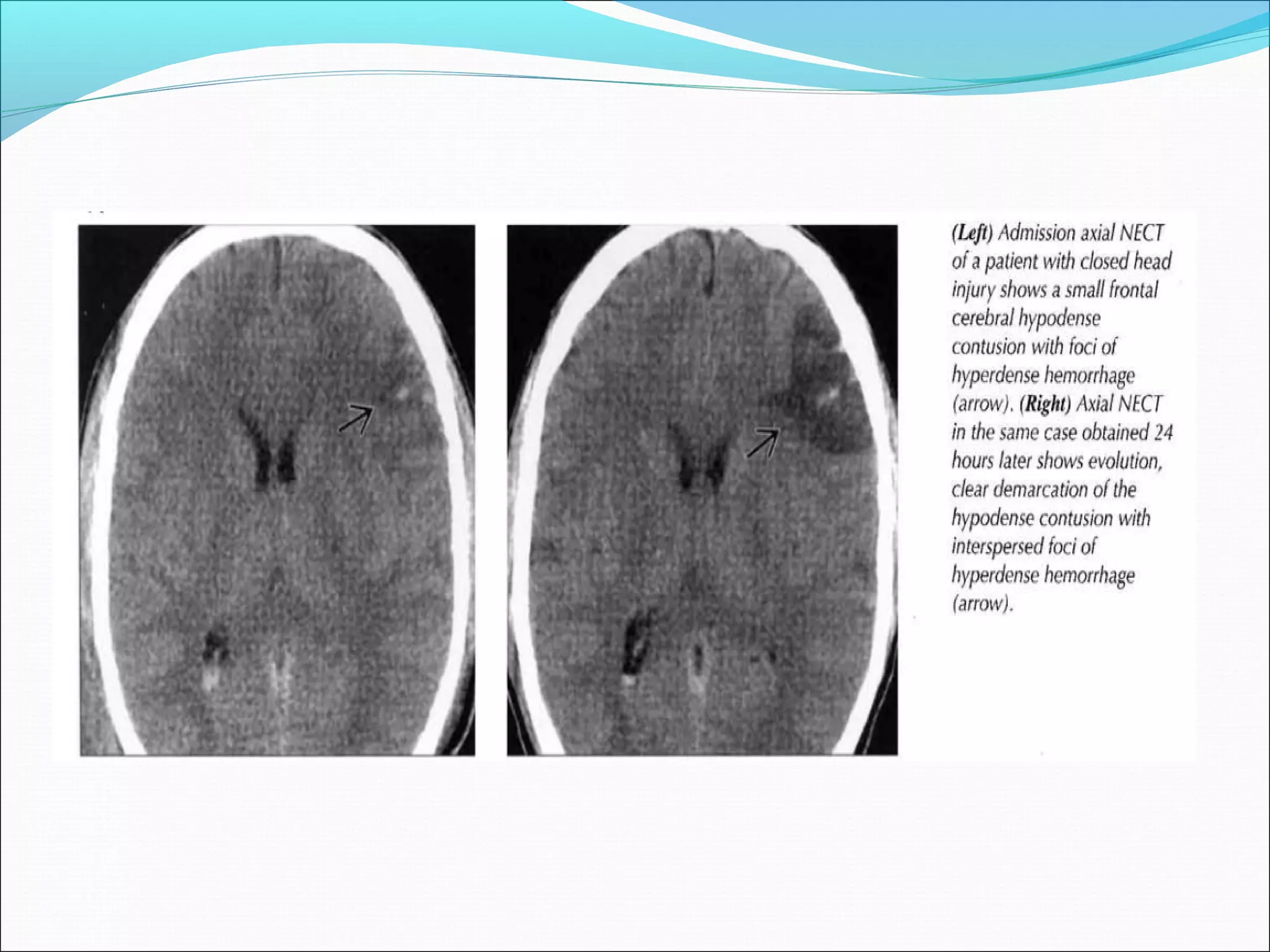 Imaging in head trauma | PPT