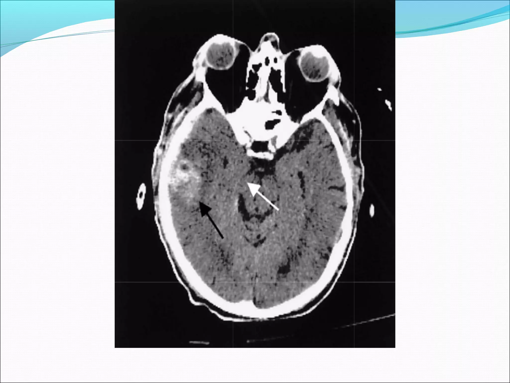 Imaging in head trauma | PPT