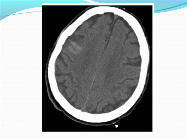 Imaging in head trauma | PPT