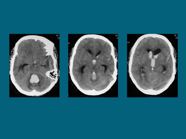 Imaging in head trauma | PPT