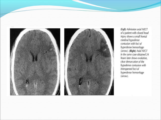 Imaging in head trauma | PPT