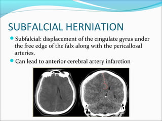 Imaging in head trauma | PPT