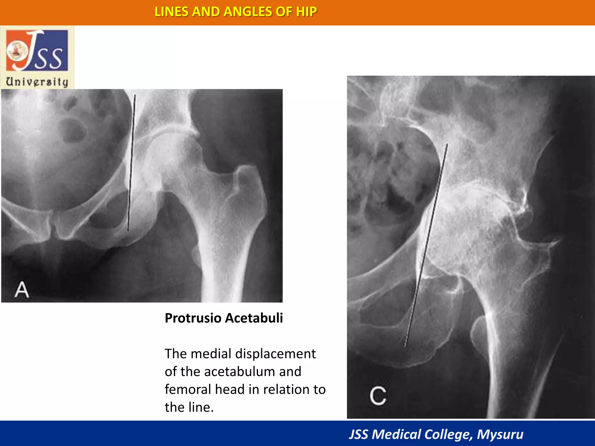 Imaging in hip disorders | PPTX