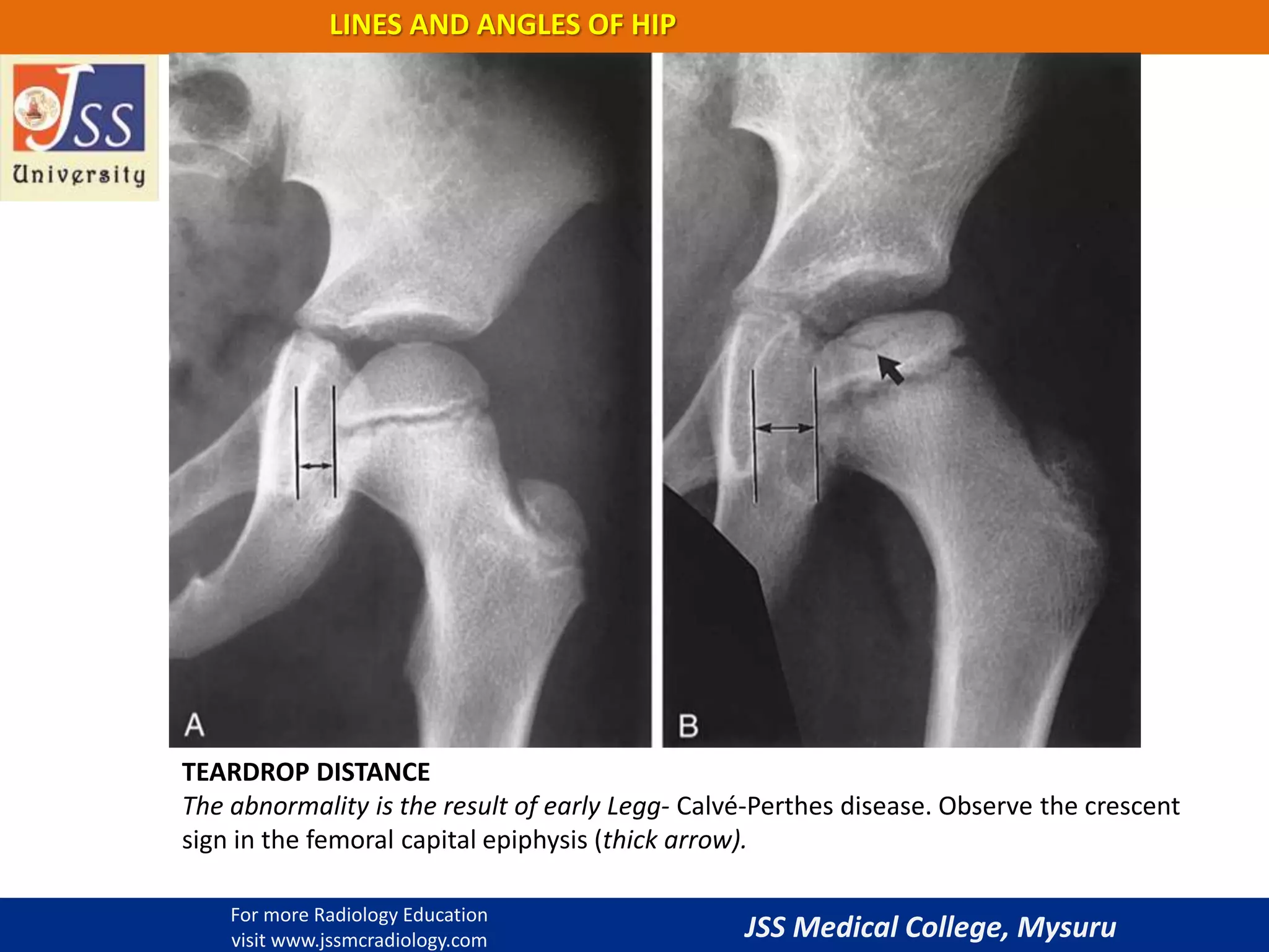 Imaging in hip disorders | PPTX