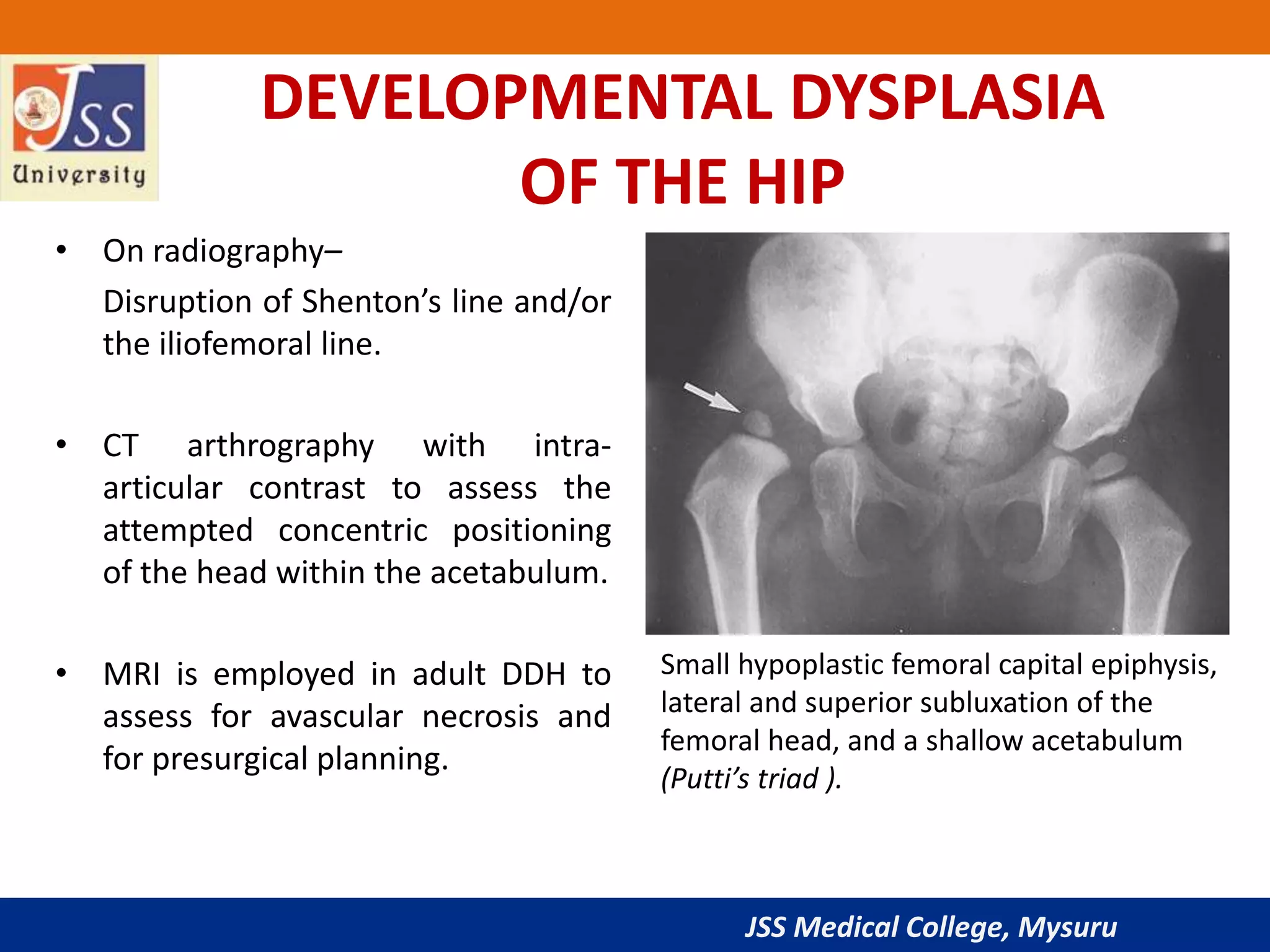Imaging in hip disorders | PPTX