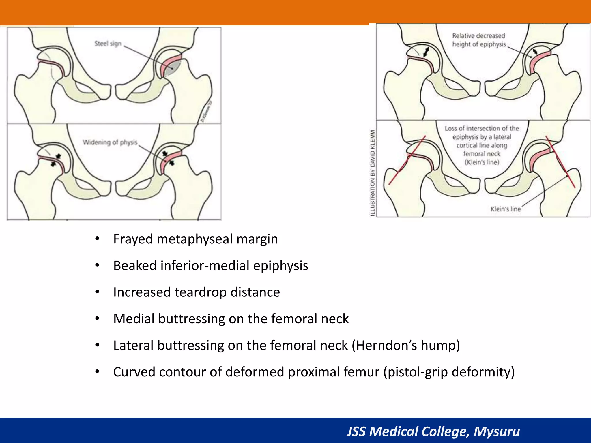 Imaging in hip disorders | PPTX