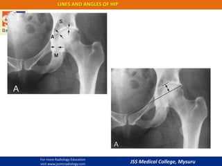 Imaging in hip disorders | PPTX