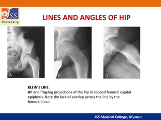 Imaging in hip disorders | PPTX
