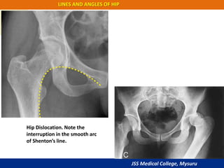 Imaging in hip disorders | PPTX