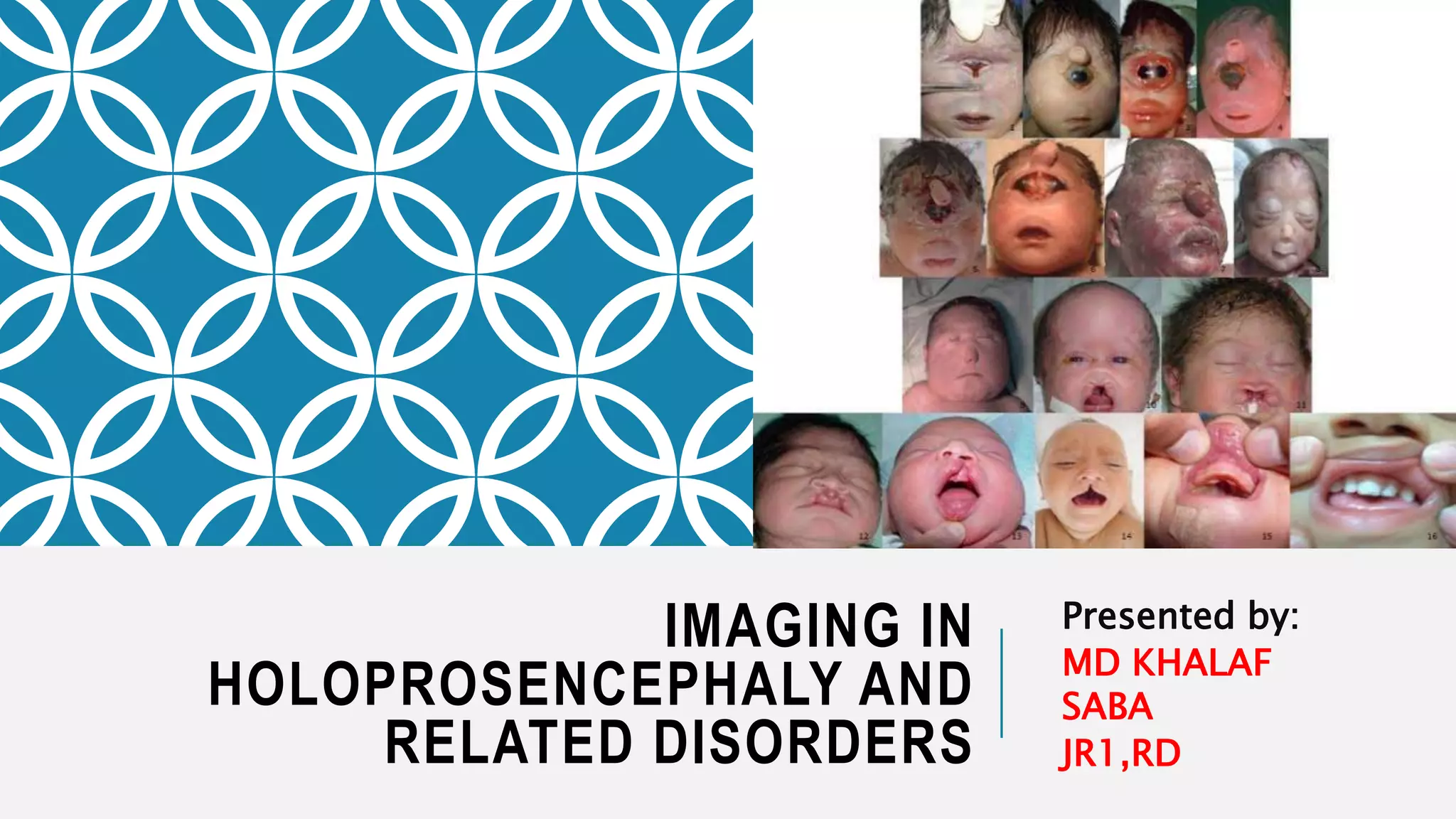 Imaging in holoprosencephaly and related disorders | PPTX