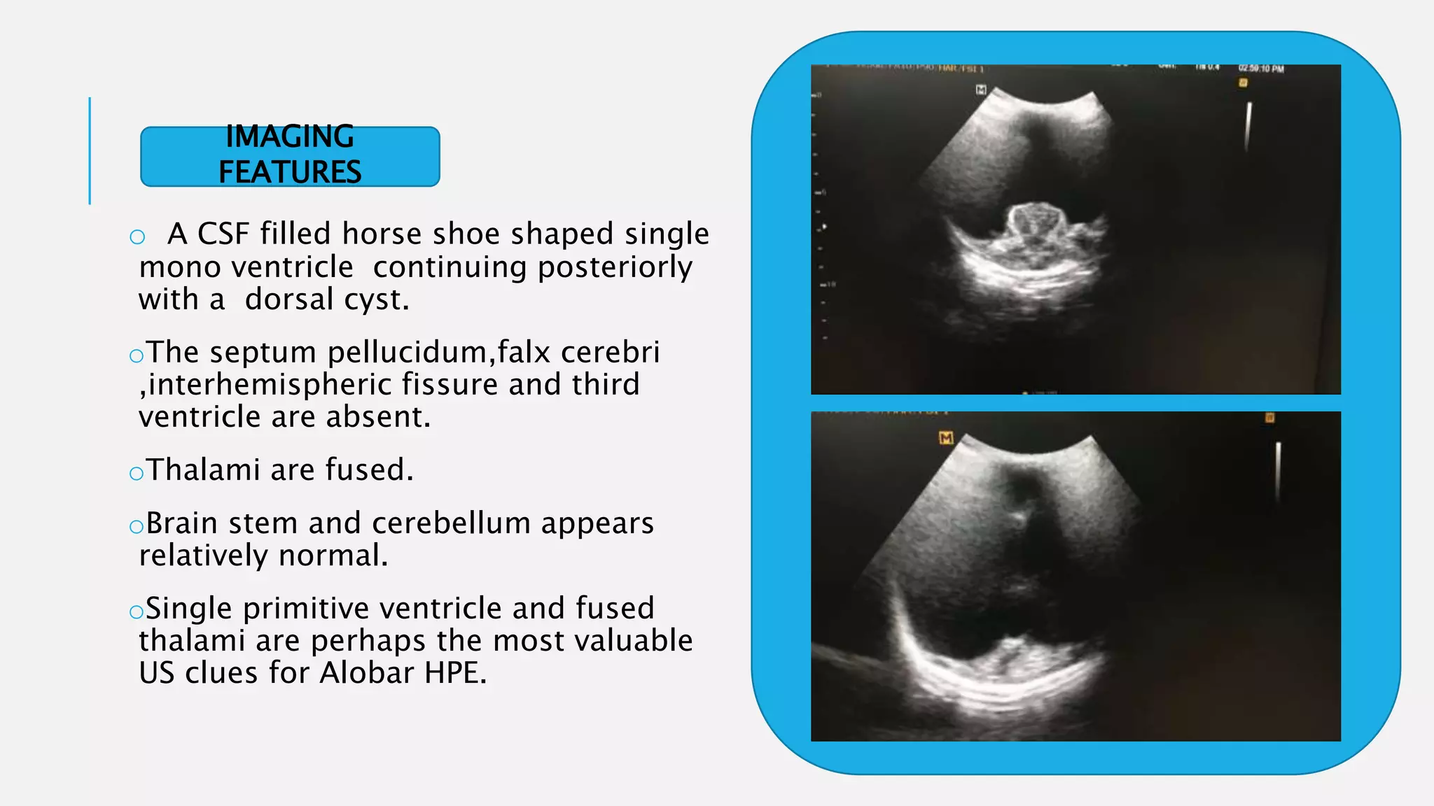 Imaging in holoprosencephaly and related disorders | PPTX