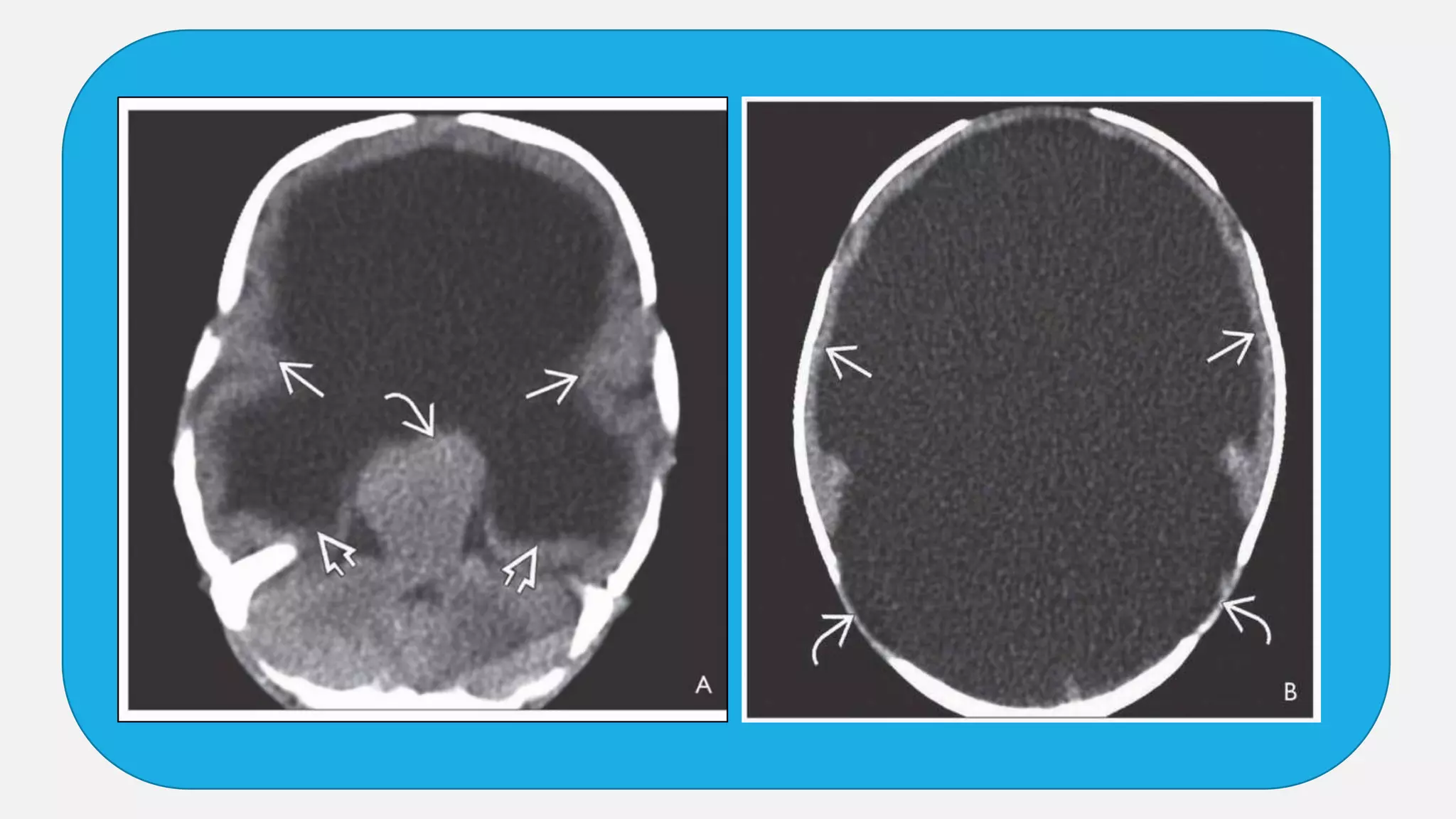Imaging in holoprosencephaly and related disorders | PPTX