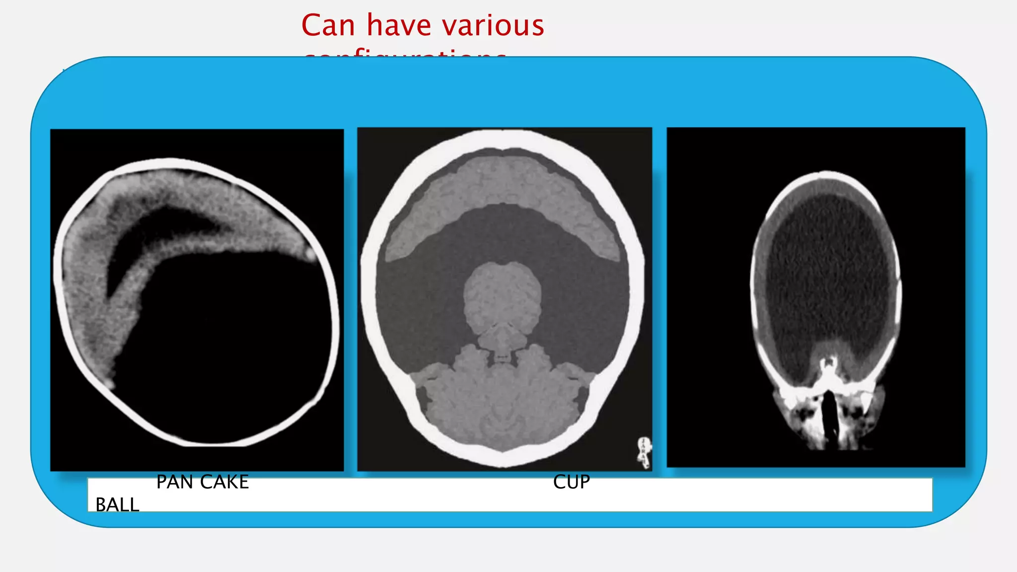 Imaging in holoprosencephaly and related disorders | PPTX