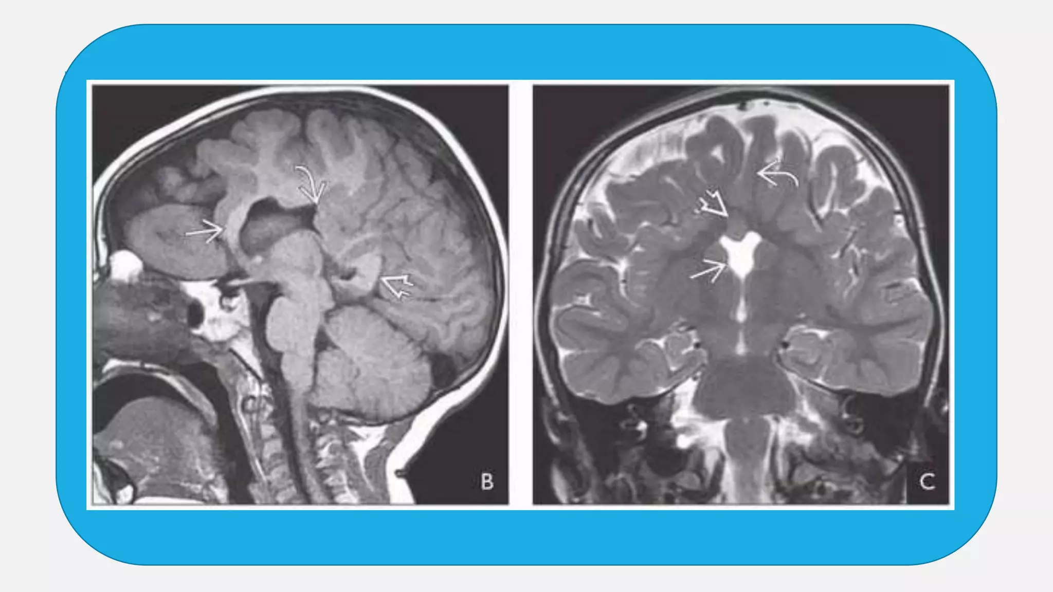 Imaging in holoprosencephaly and related disorders | PPT
