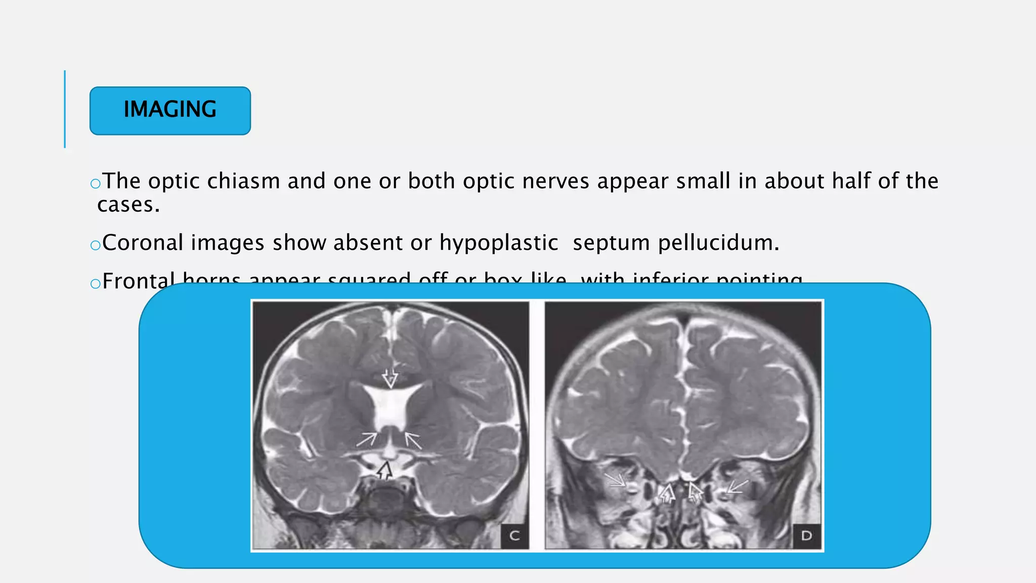 Imaging in holoprosencephaly and related disorders | PPTX