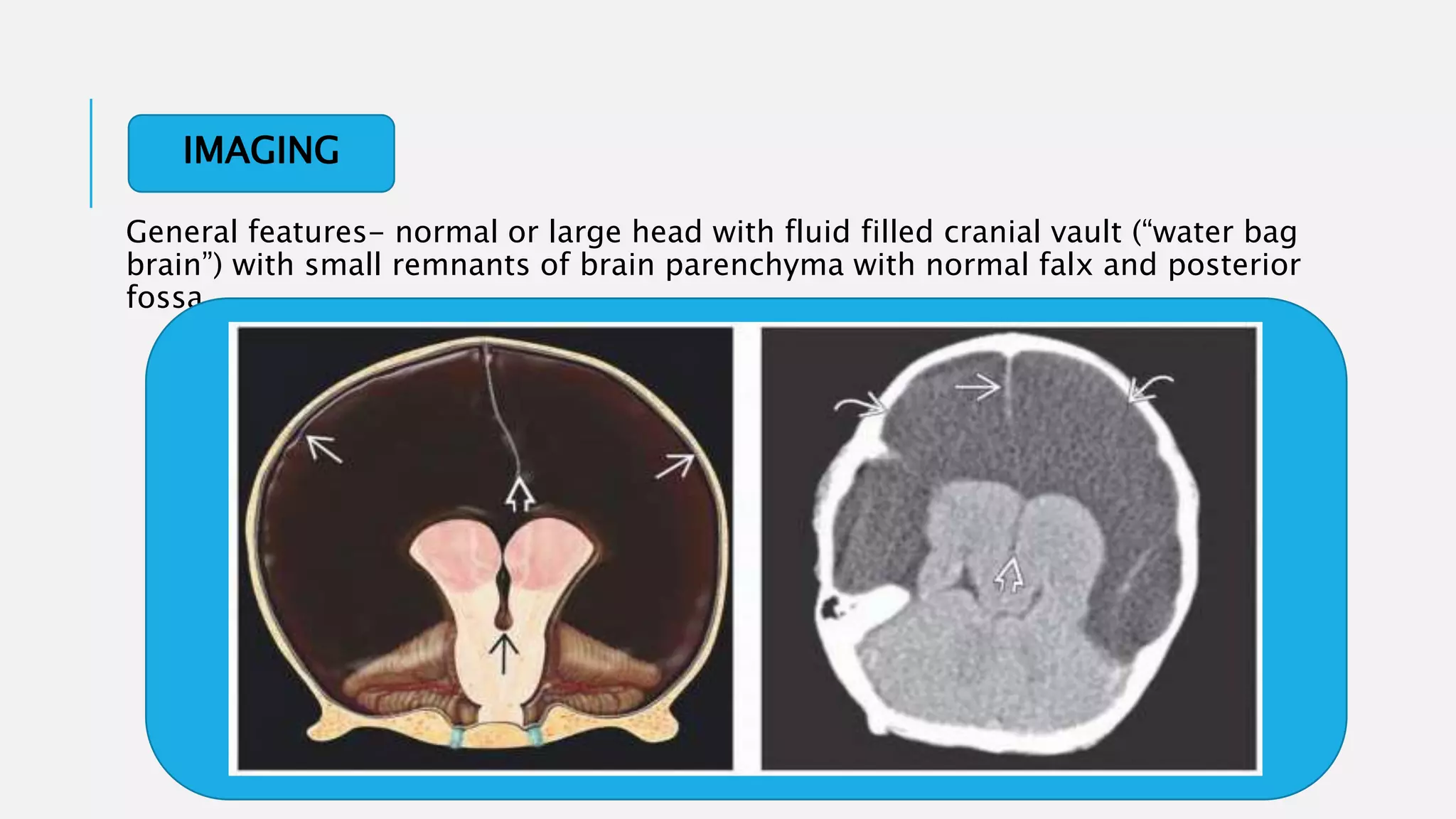 Imaging in holoprosencephaly and related disorders | PPTX