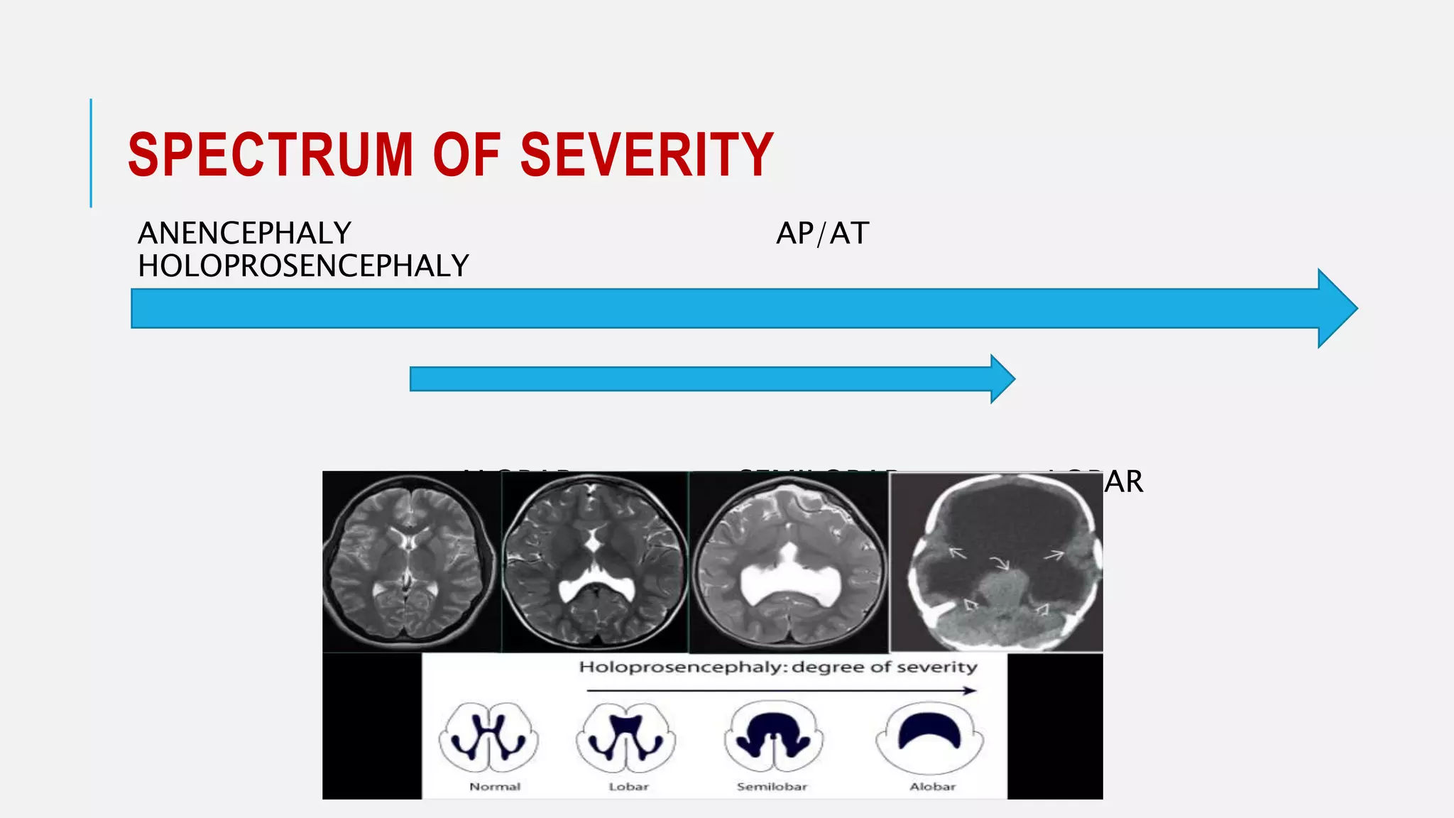 Imaging in holoprosencephaly and related disorders | PPTX