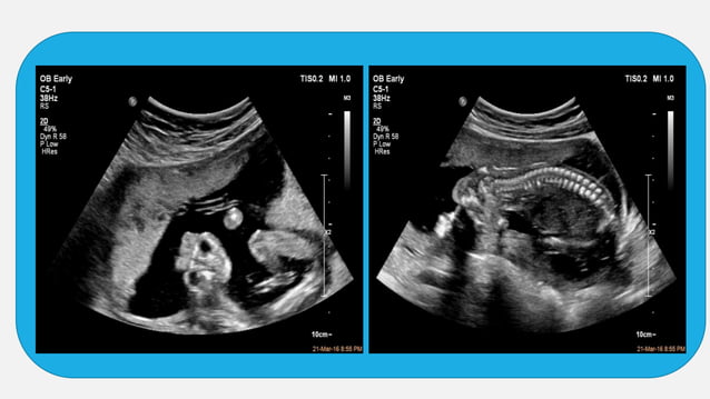 Imaging in holoprosencephaly and related disorders | PPT