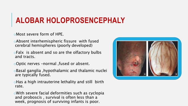 Imaging in holoprosencephaly and related disorders | PPT