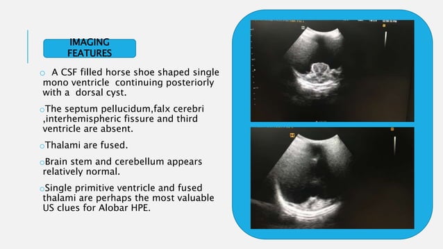 Imaging in holoprosencephaly and related disorders | PPT