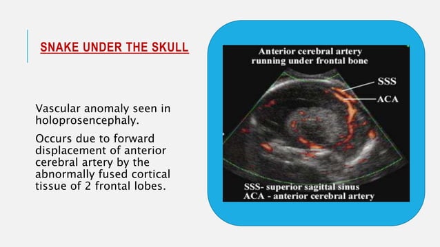 Imaging in holoprosencephaly and related disorders | PPT