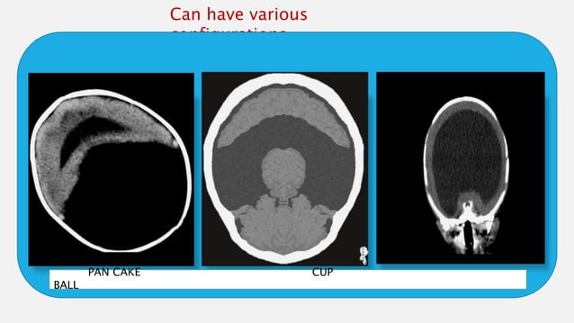 Imaging in holoprosencephaly and related disorders | PPT