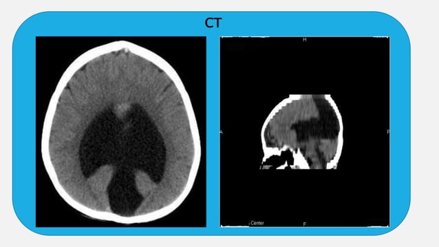 Imaging in holoprosencephaly and related disorders | PPT