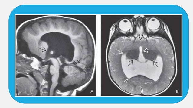 Imaging in holoprosencephaly and related disorders | PPT