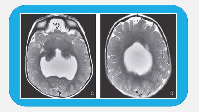 Imaging in holoprosencephaly and related disorders | PPT