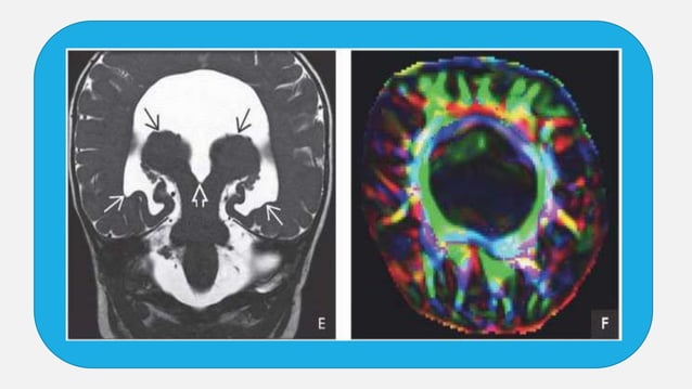Imaging in holoprosencephaly and related disorders | PPT