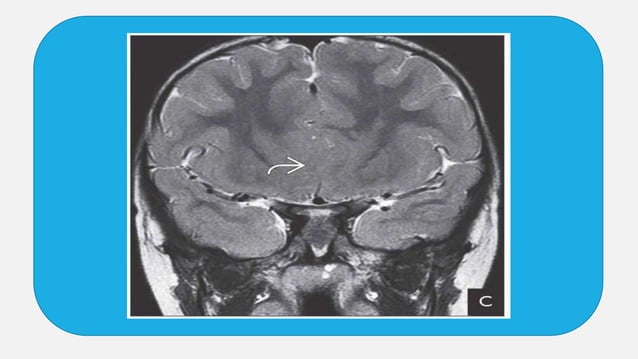 Imaging in holoprosencephaly and related disorders | PPT