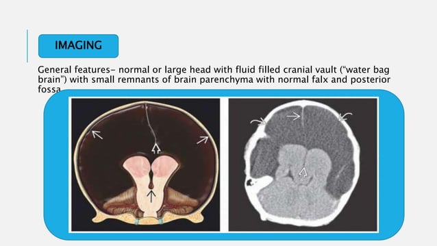 Imaging in holoprosencephaly and related disorders | PPT