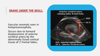 Imaging in holoprosencephaly and related disorders | PPT