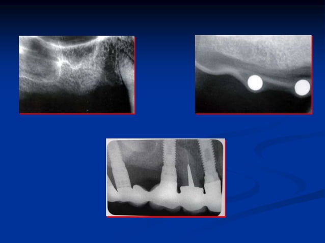 imaging in implantology.ppt | Dental Health | Diseases and Conditions