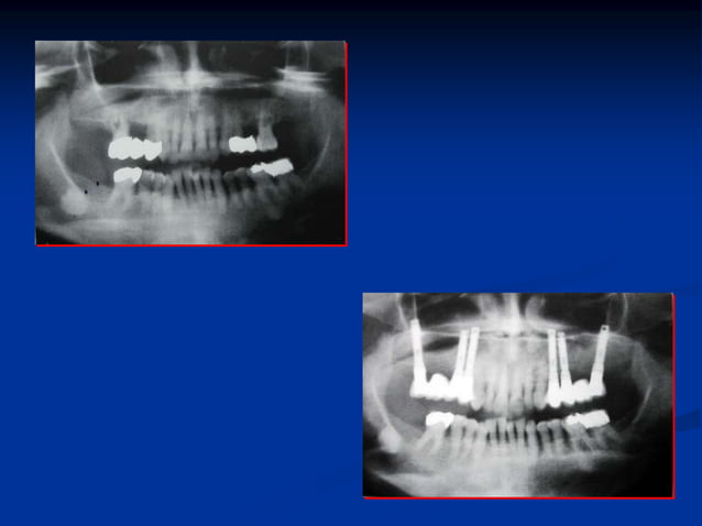 imaging in implantology.ppt | Dental Health | Diseases and Conditions
