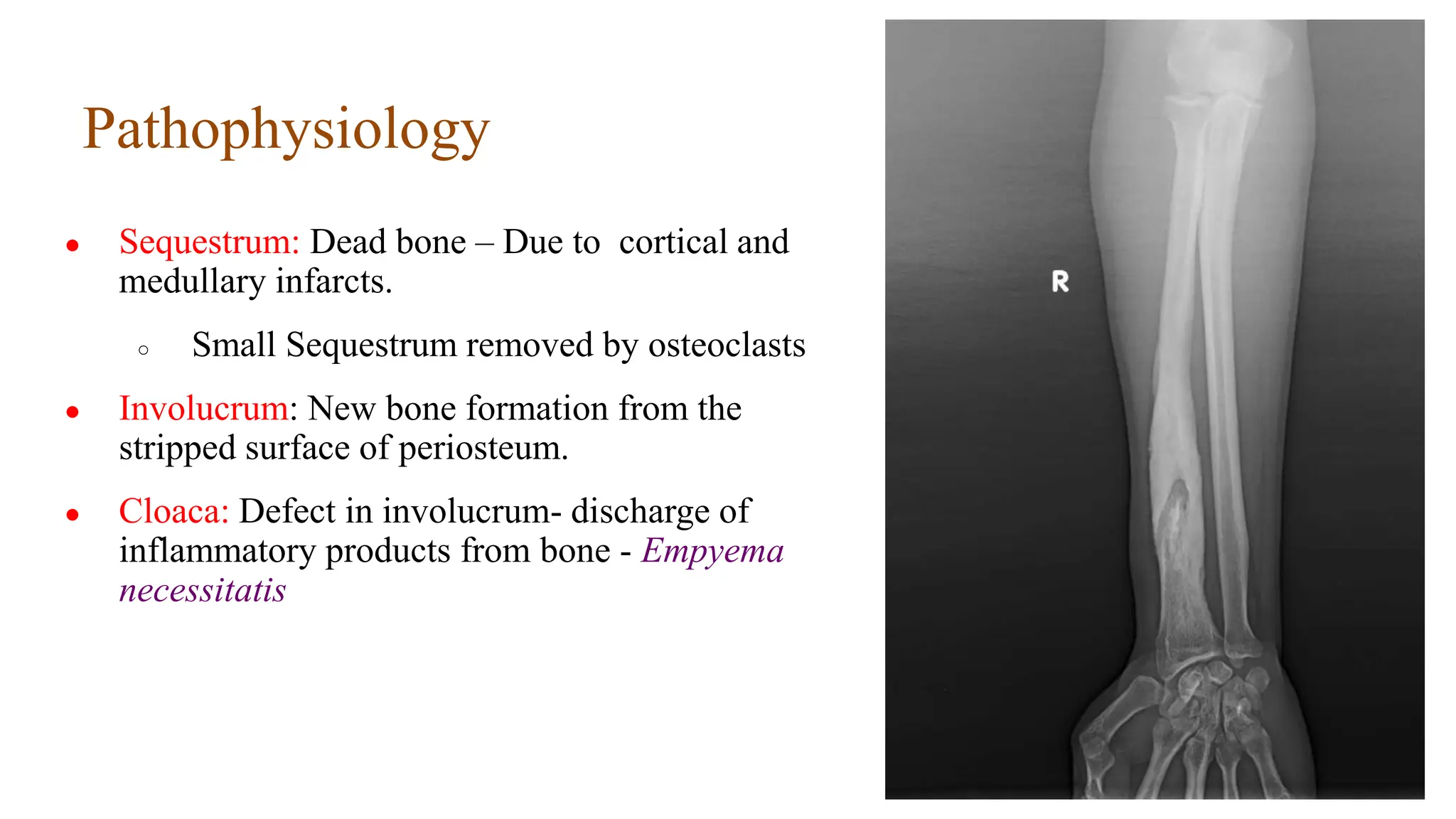 Imaging in infections of bones and joints2.pptx