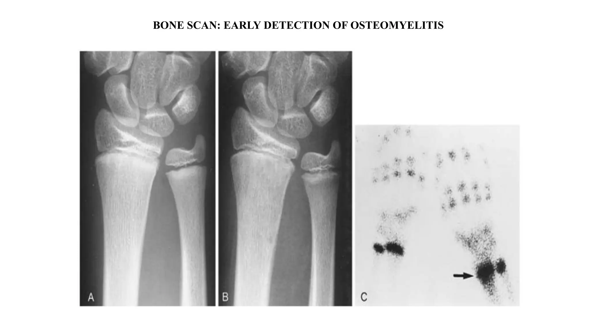 Imaging in infections of bones and joints2.pptx