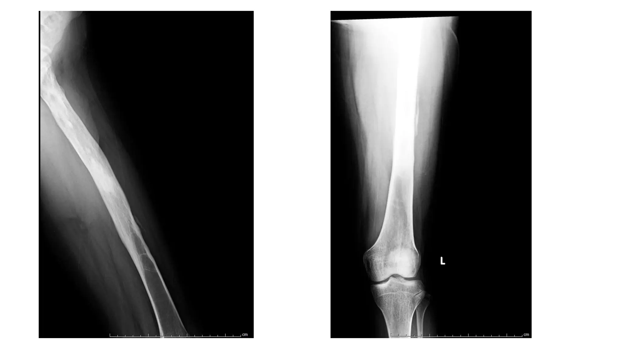 Imaging in infections of bones and joints2.pptx