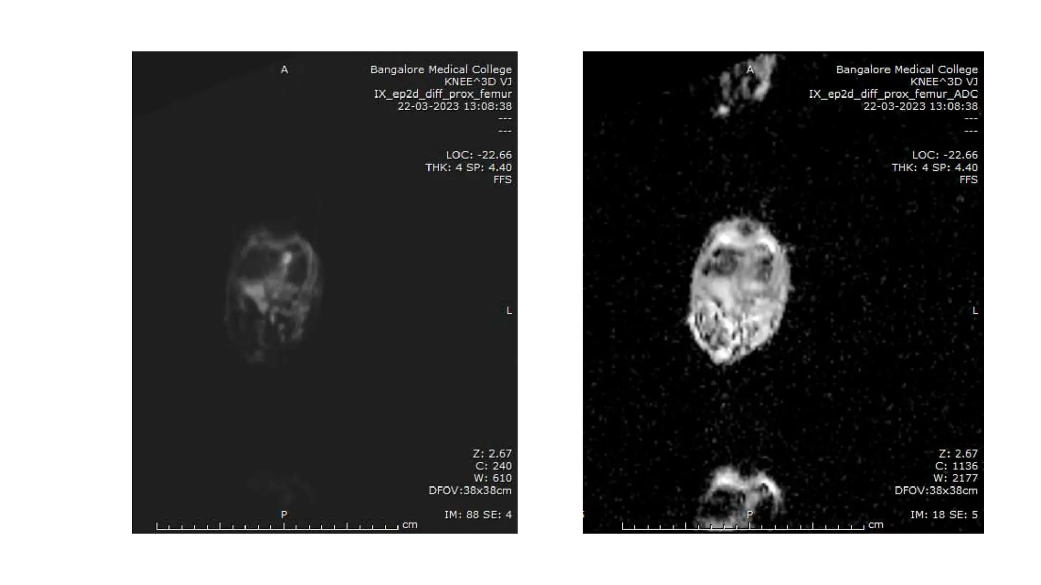 Imaging in infections of bones and joints2.pptx