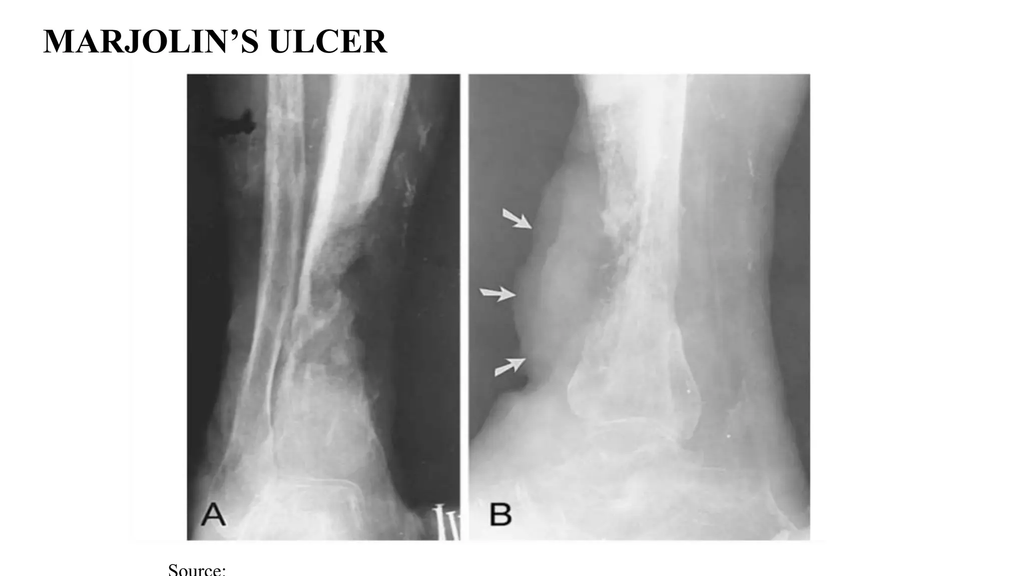 Imaging in infections of bones and joints2.pptx