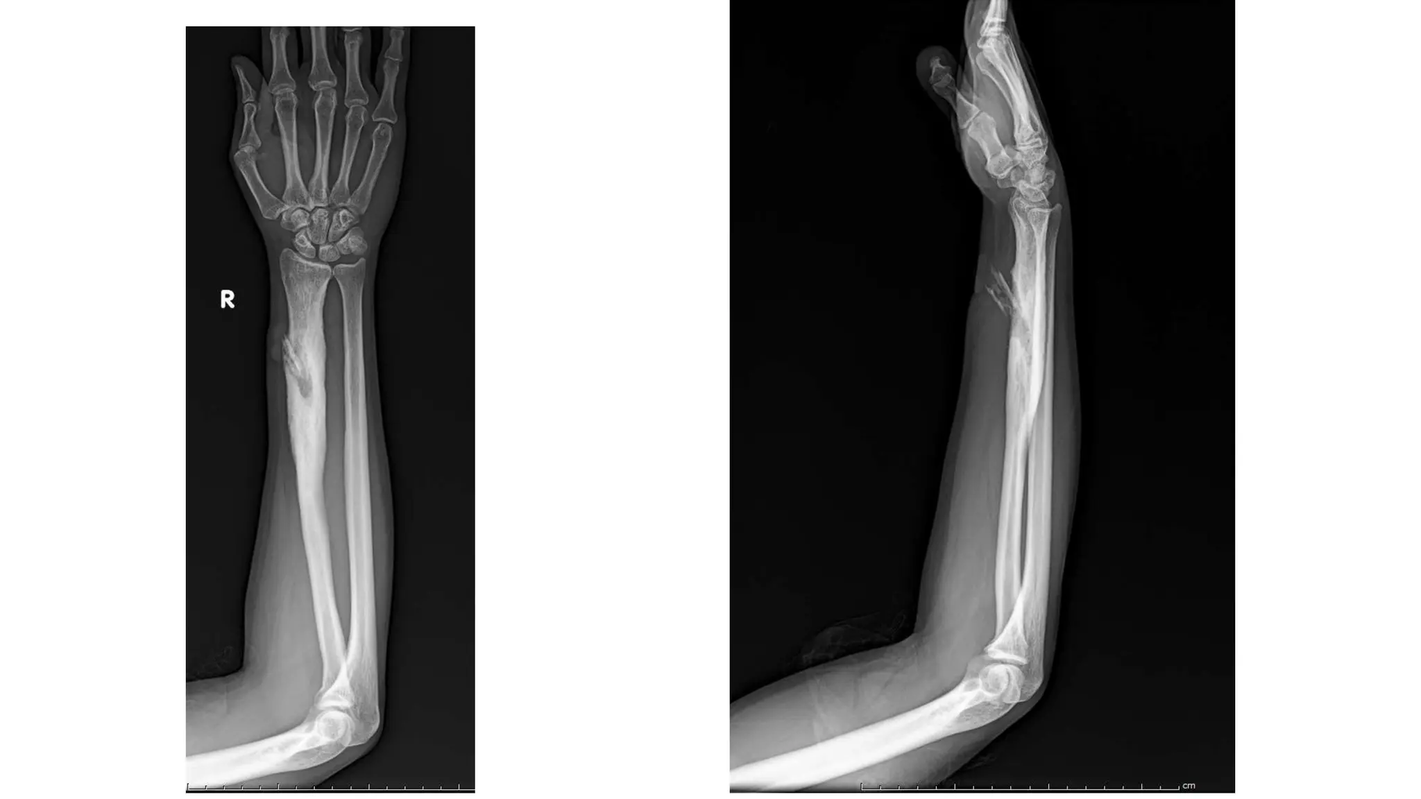 Imaging in infections of bones and joints2.pptx