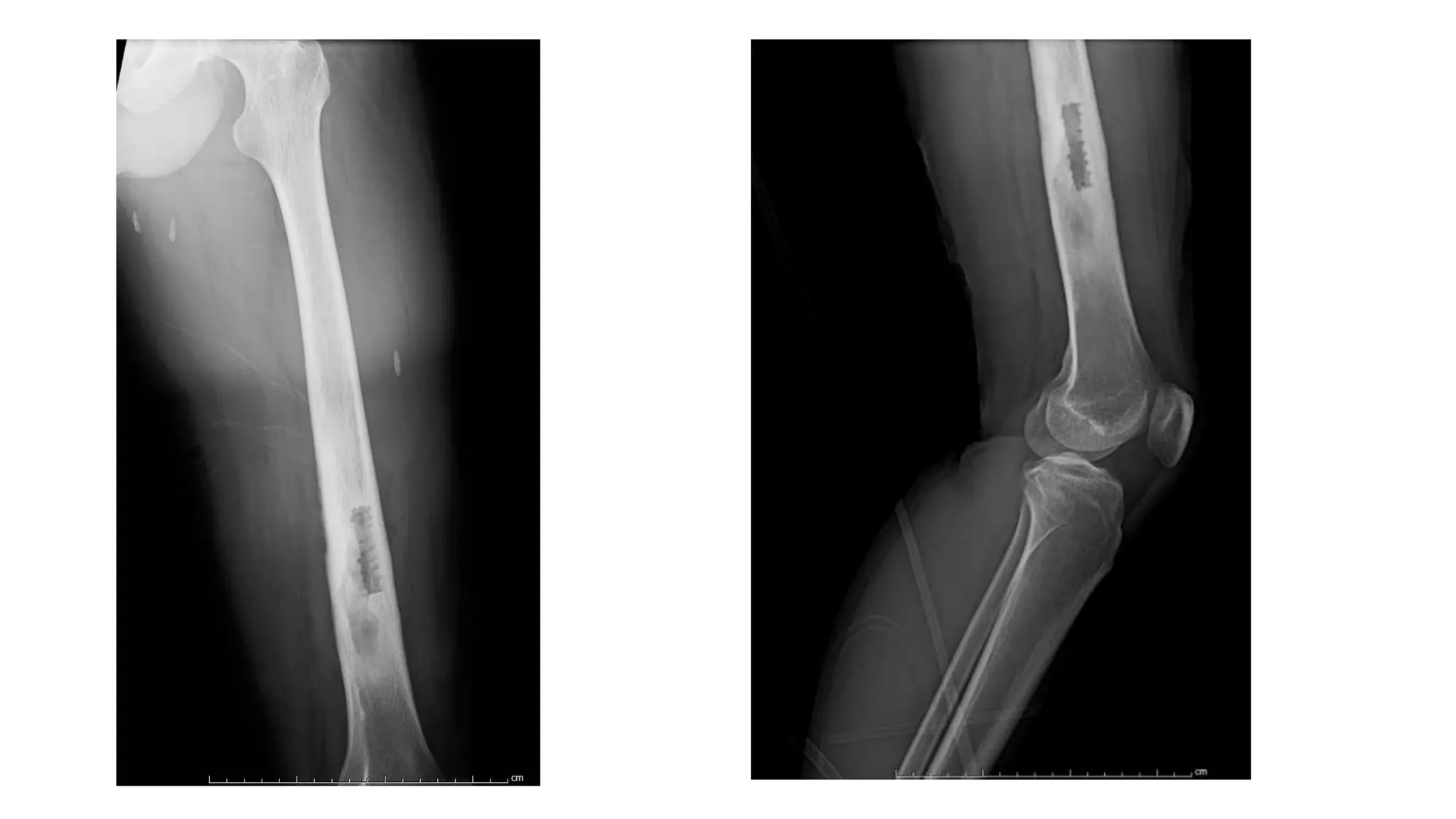 Imaging in infections of bones and joints2.pptx