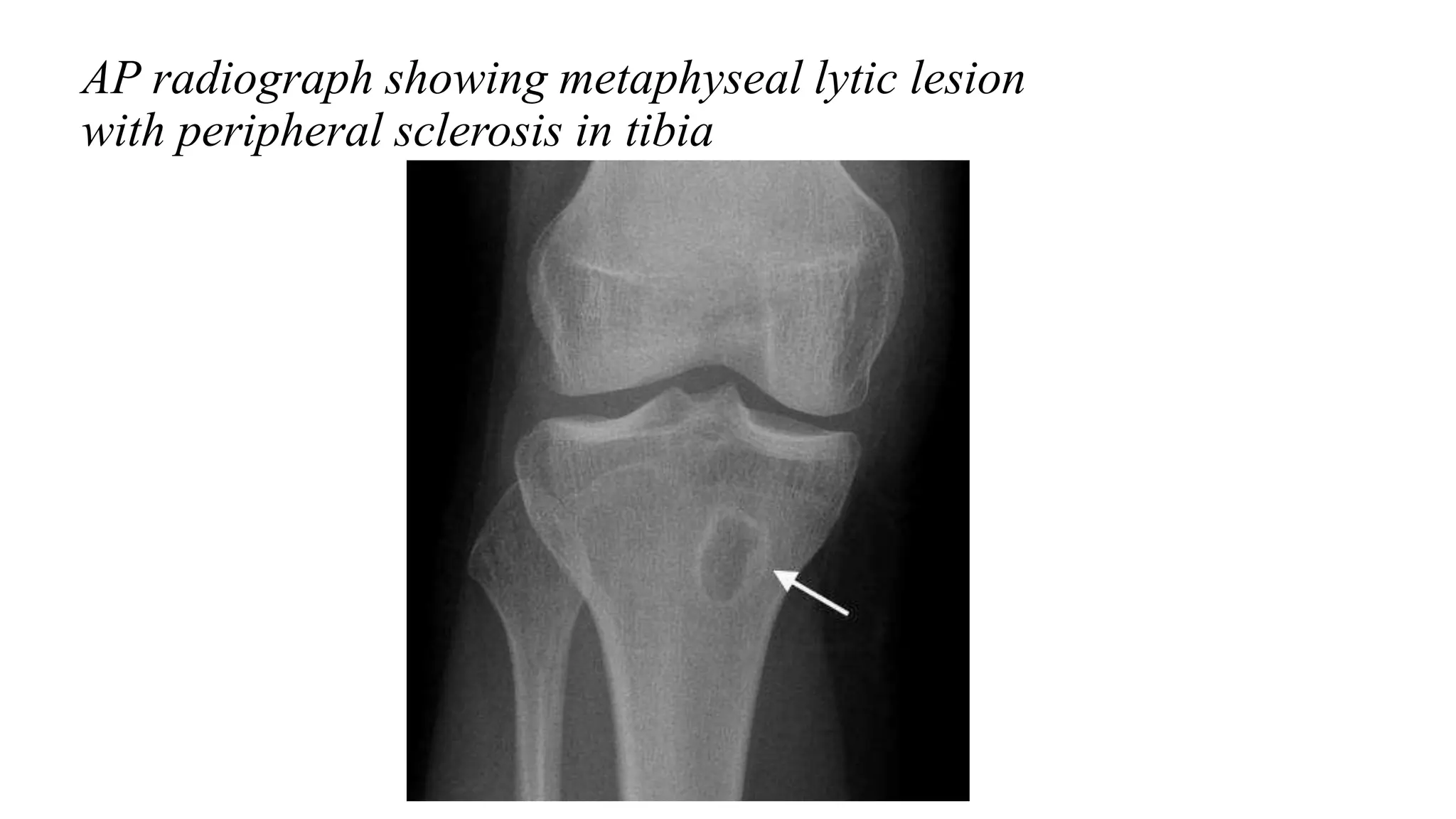 Imaging in infections of bones and joints2.pptx
