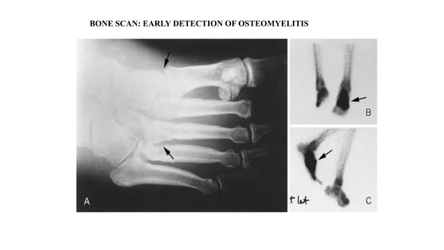 Imaging in infections of bones and joints2.pptx
