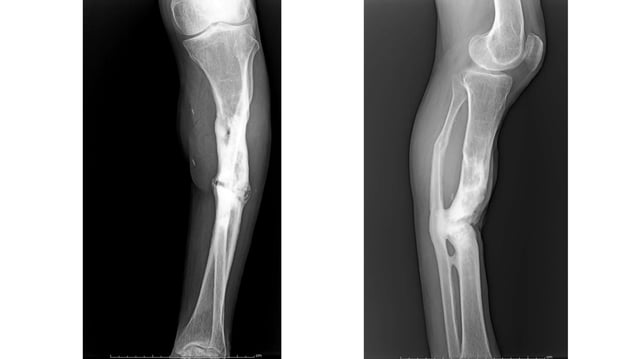 Imaging in infections of bones and joints2.pptx